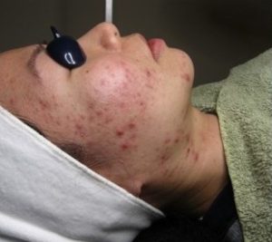 How does benzoyl peroxide work and what type of acne does it work best ...