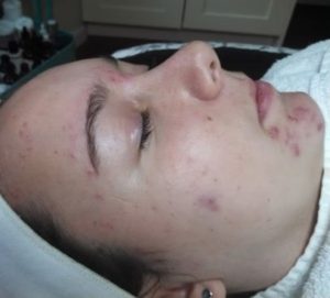 How does benzoyl peroxide work and what type of acne does it work best ...